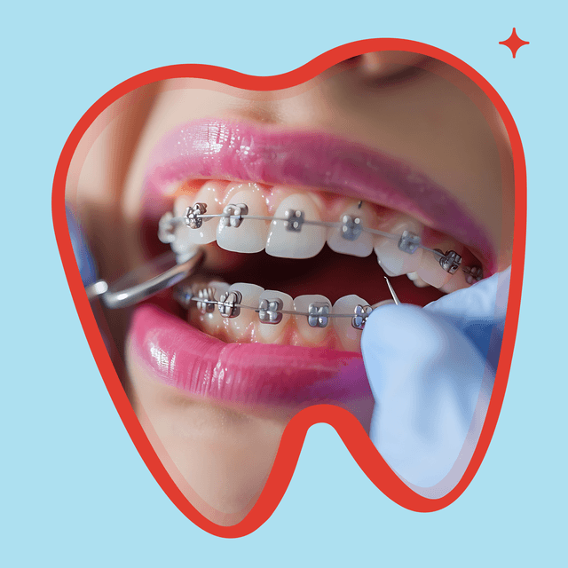 Aligners VS Braces: Cost, Comfort & Results | Toothsi