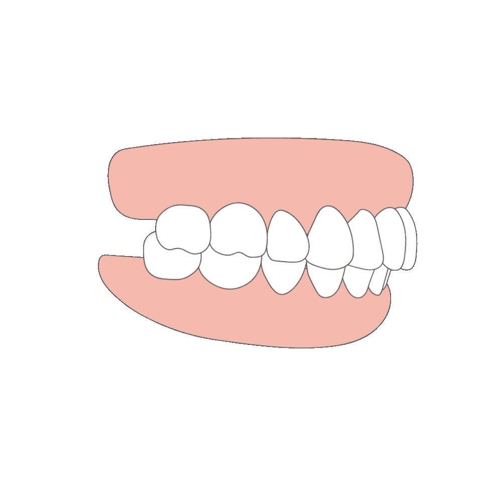 Clear Aligners & Invisible Teeth Braces | makeO Toothsi
